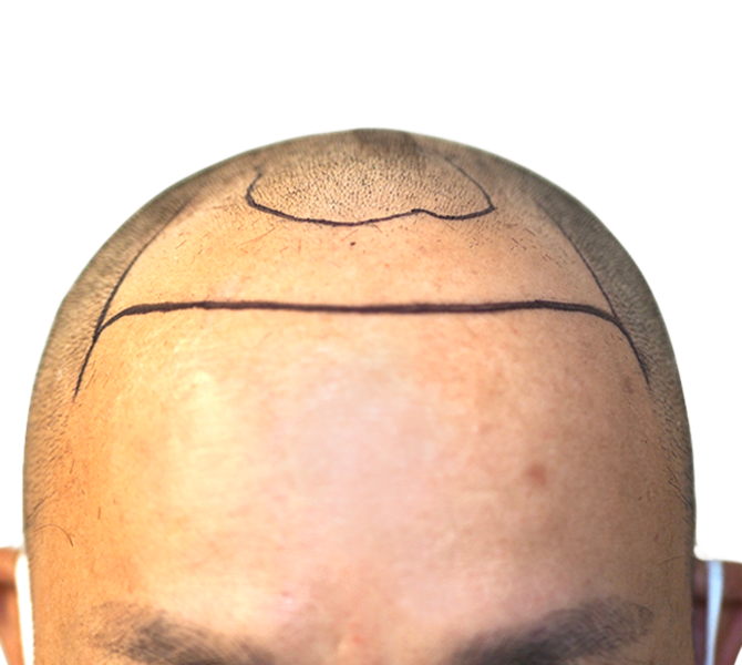 The Hair Transplant Center – New Jersey | FUE, FUT & More Hair ...