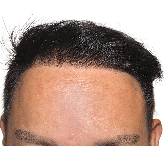 The Hair Transplant Center – New Jersey | FUE, FUT & More Hair ...