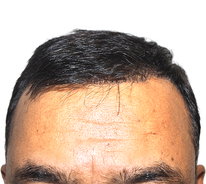 The Hair Transplant Center – New Jersey | FUE, FUT & More Hair ...