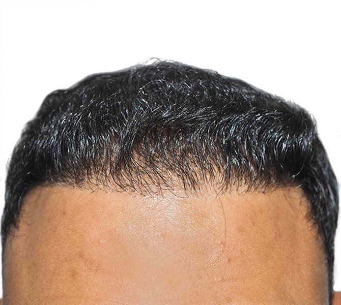 The Hair Transplant Center – New Jersey | FUE, FUT & More Hair ...