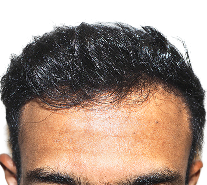 The Hair Transplant Center – New Jersey | FUE, FUT & More Hair ...