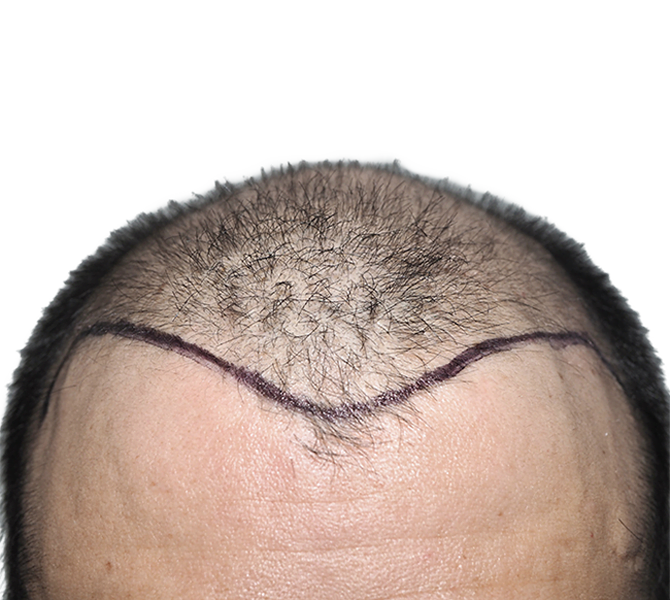 The Hair Transplant Center – New Jersey | FUE, FUT & More Hair ...