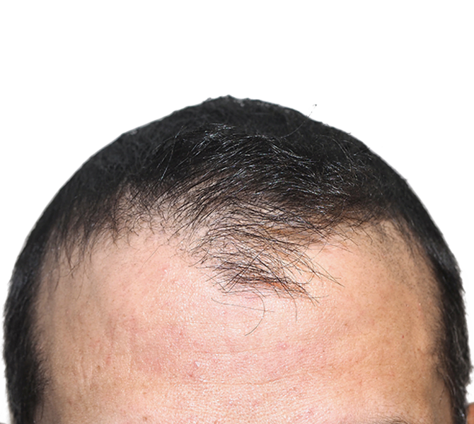 The Hair Transplant Center – New Jersey | FUE, FUT & More Hair ...