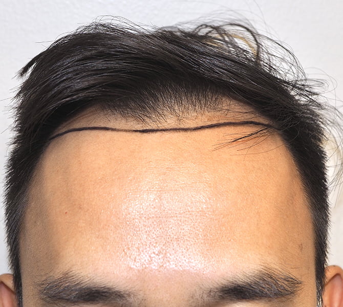 The Hair Transplant Center – New Jersey | FUE, FUT & More Hair ...
