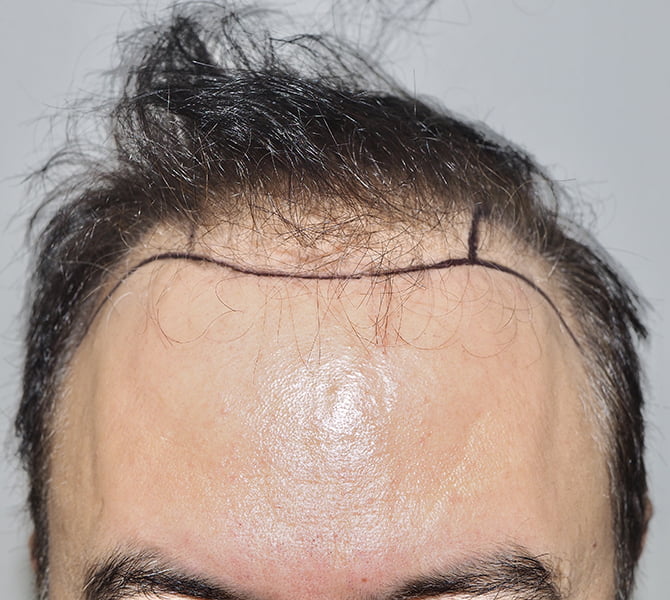 The Hair Transplant Center – New Jersey | FUE, FUT & More Hair ...