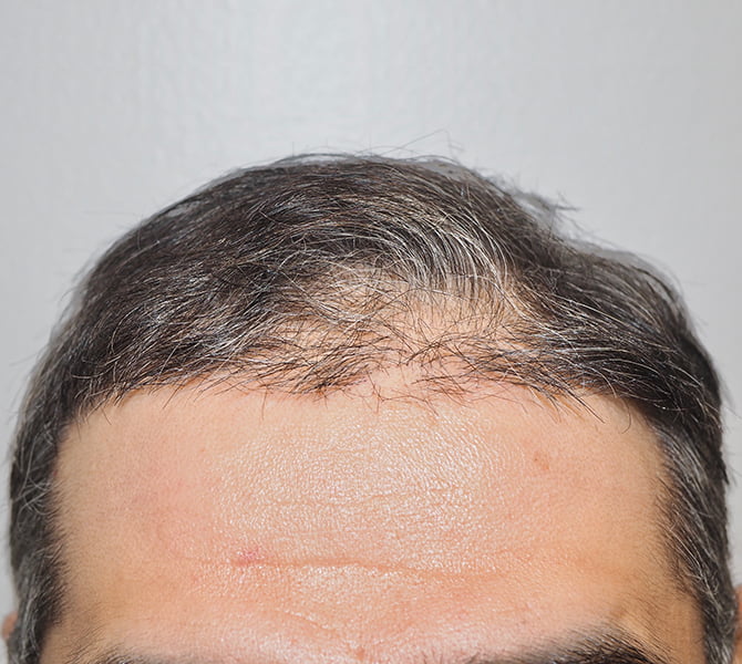 The Hair Transplant Center – New Jersey | FUE, FUT & More Hair ...