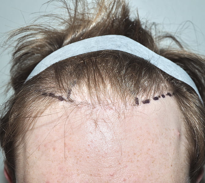 The Hair Transplant Center – New Jersey | FUE, FUT & More Hair ...