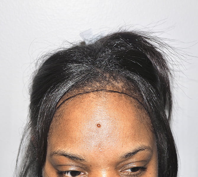 The Hair Transplant Center – New Jersey | FUE, FUT & More Hair ...