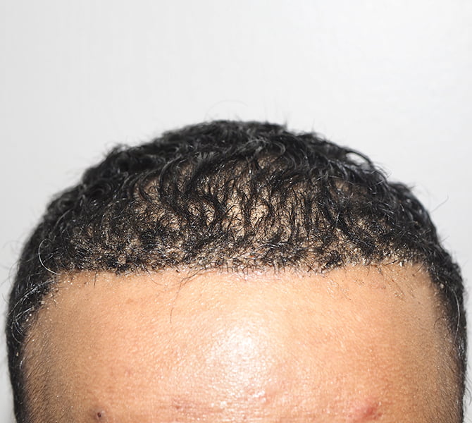 The Hair Transplant Center – New Jersey | FUE, FUT & More Hair ...