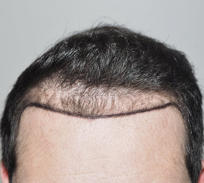 The Hair Transplant Center – New Jersey | FUE, FUT & More Hair ...