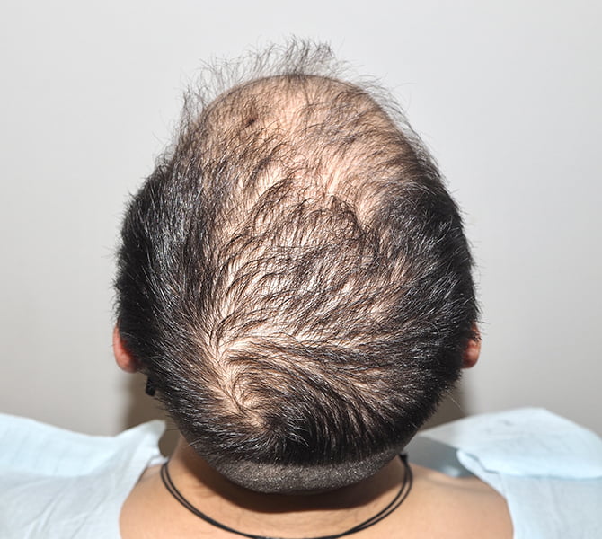 The Hair Transplant Center – New Jersey | FUE, FUT & More Hair ...