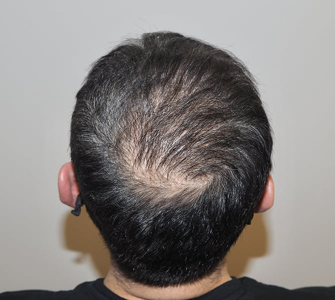 The Hair Transplant Center – New Jersey | FUE, FUT & More Hair ...