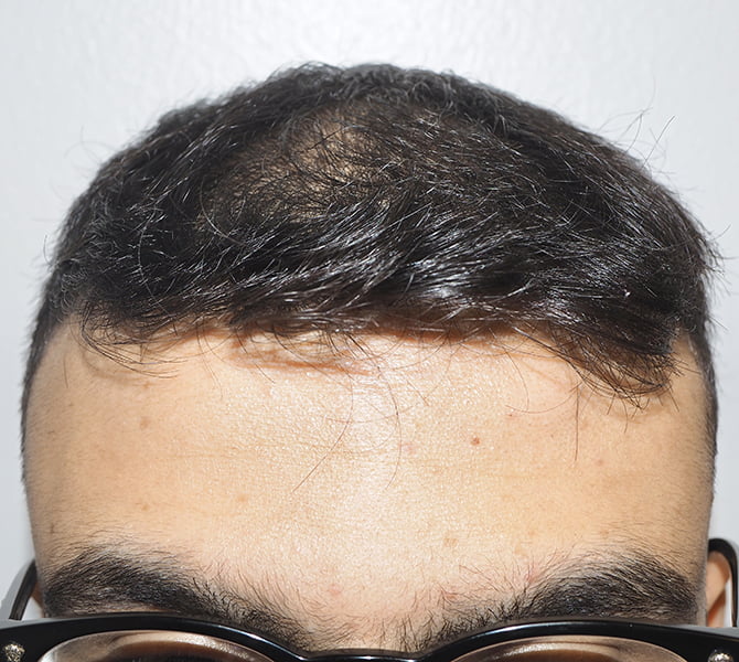 The Hair Transplant Center – New Jersey | FUE, FUT & More Hair ...