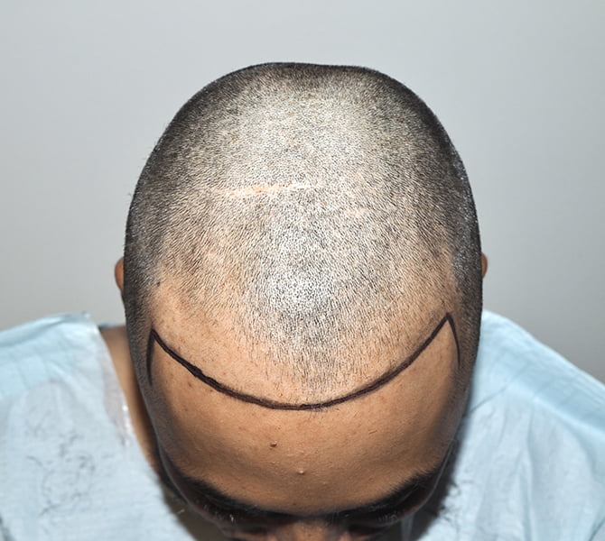 The Hair Transplant Center – New Jersey | FUE, FUT & More Hair ...