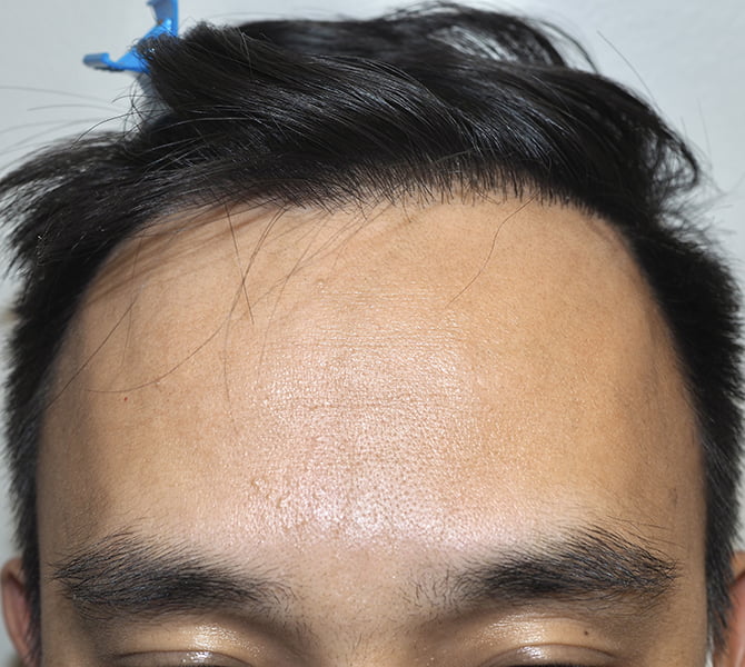 The Hair Transplant Center – New Jersey | FUE, FUT & More Hair ...