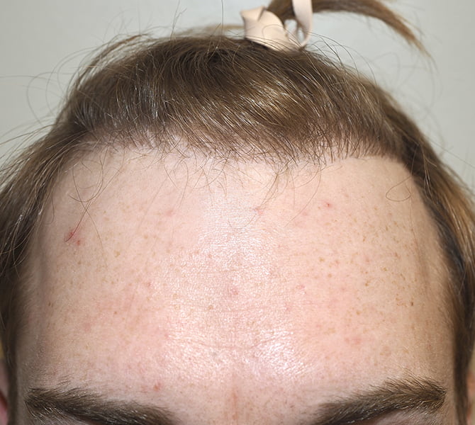 The Hair Transplant Center – New Jersey | FUE, FUT & More Hair ...