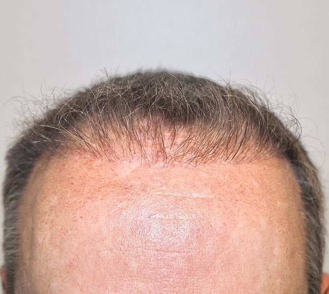 The Hair Transplant Center – New Jersey | FUE, FUT & More Hair ...