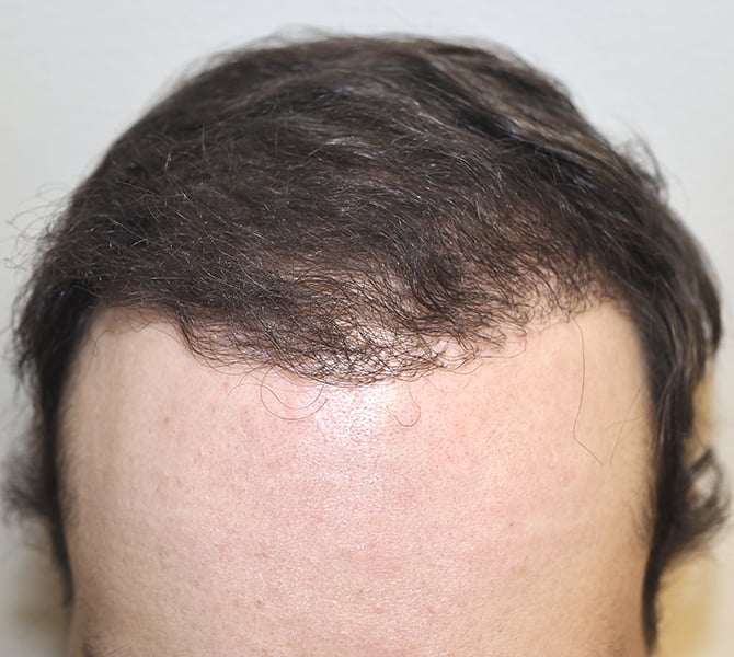 The Hair Transplant Center – New Jersey | FUE, FUT & More Hair ...