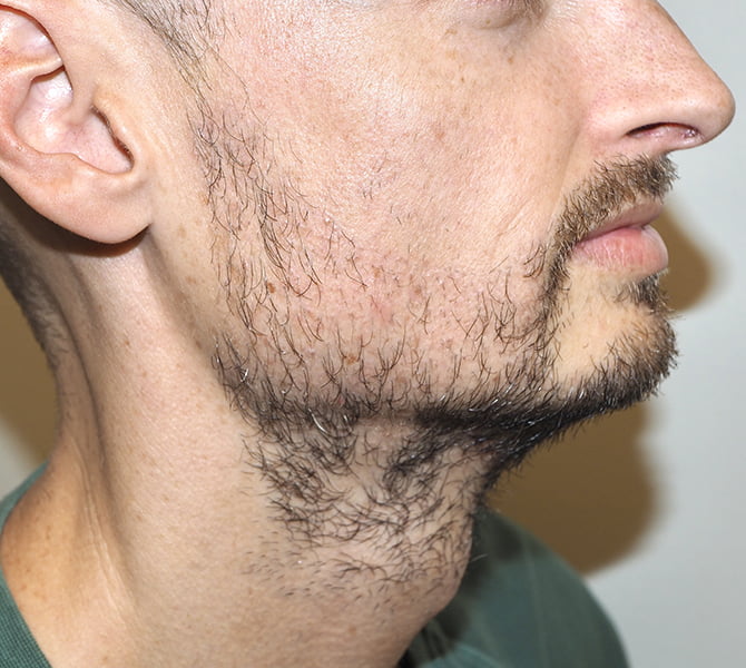 The Hair Transplant Center – New Jersey | FUE, FUT & More Hair ...