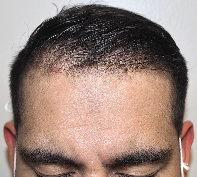 The Hair Transplant Center – New Jersey | FUE, FUT & More Hair ...