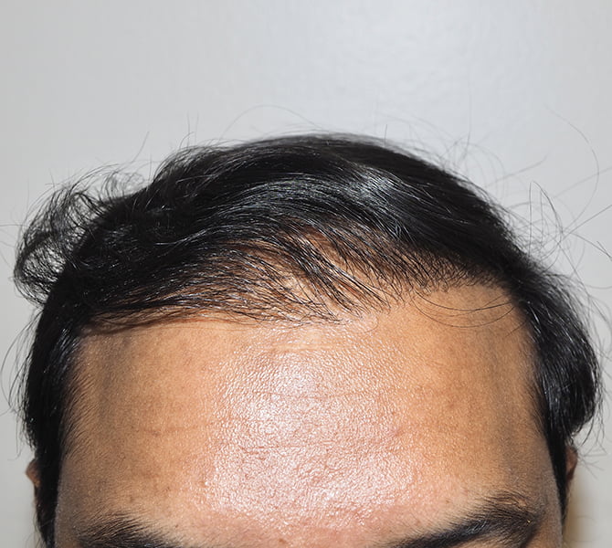 The Hair Transplant Center – New Jersey | FUE, FUT & More Hair ...