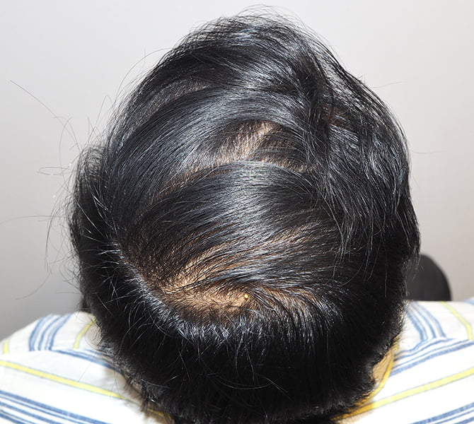 The Hair Transplant Center – New Jersey | FUE, FUT & More Hair ...