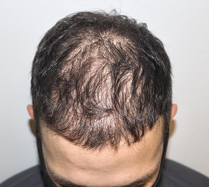 The Hair Transplant Center – New Jersey | FUE, FUT & More Hair ...