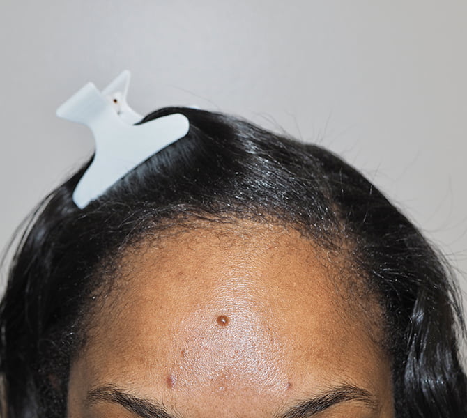 The Hair Transplant Center – New Jersey | FUE, FUT & More Hair ...