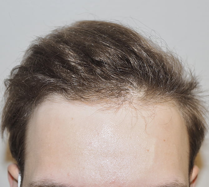 The Hair Transplant Center – New Jersey | FUE, FUT & More Hair ...