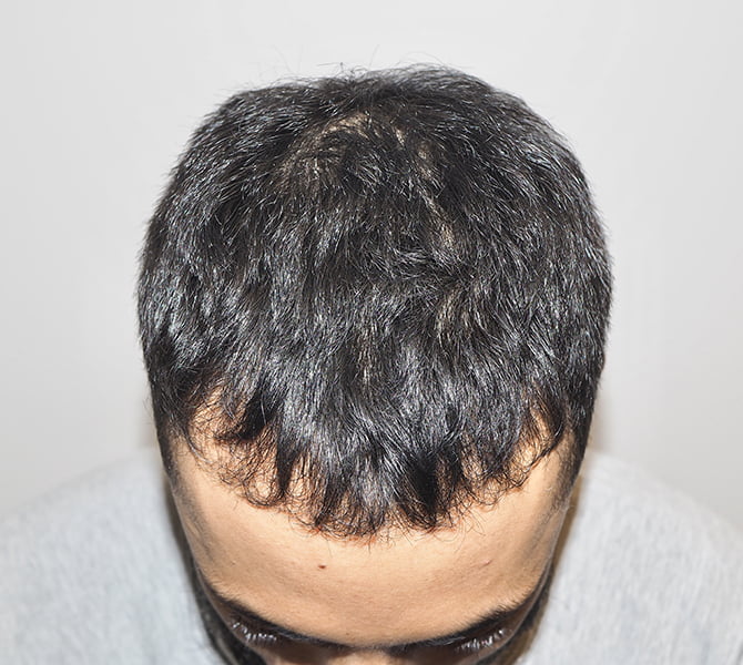 The Hair Transplant Center – New Jersey | FUE, FUT & More Hair ...