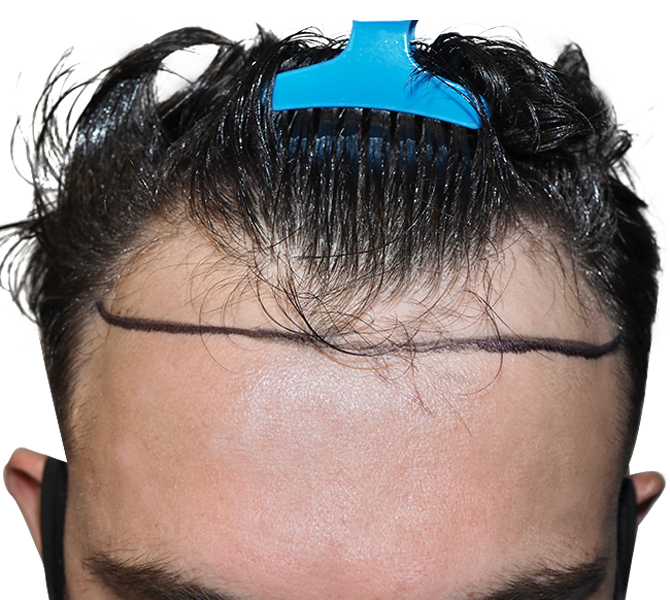 The Hair Transplant Center – New Jersey | FUE, FUT & More Hair ...