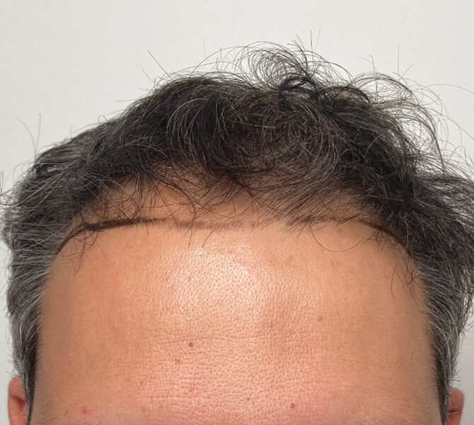 The Hair Transplant Center – New Jersey | FUE, FUT & More Hair ...