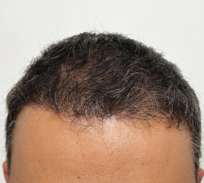 The Hair Transplant Center – New Jersey | FUE, FUT & More Hair ...